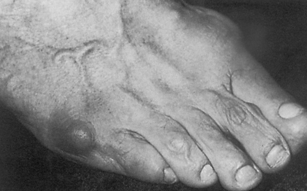 Bunionette Deformity - Foot & Ankle - Orthobullets